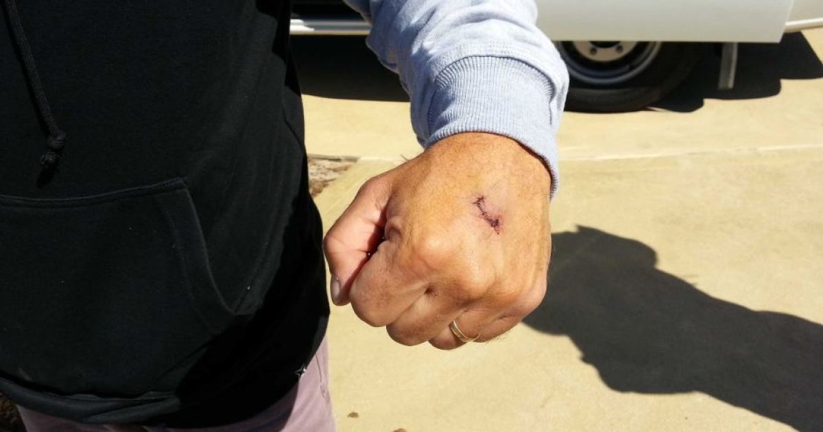 'It could have easily taken my hand' | The New Daily