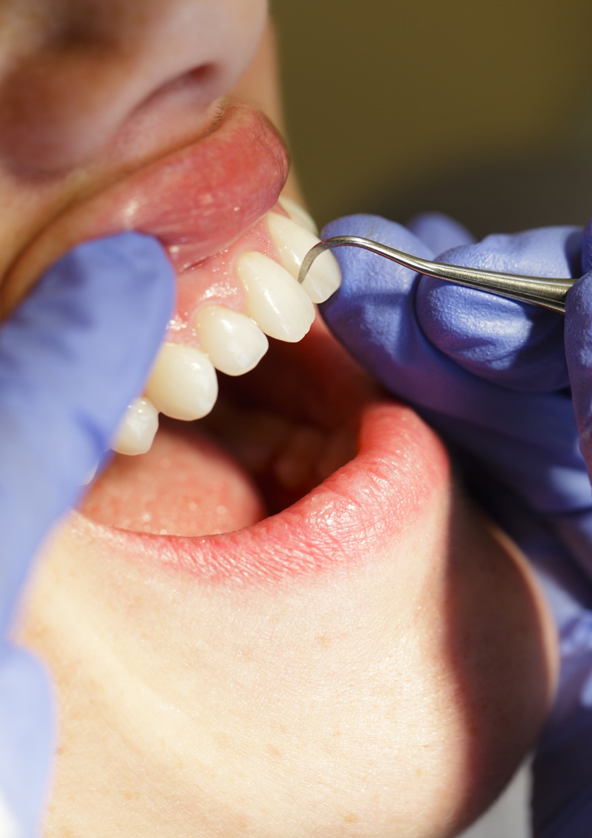 Frightening consequences of not brushing teeth | The New Daily