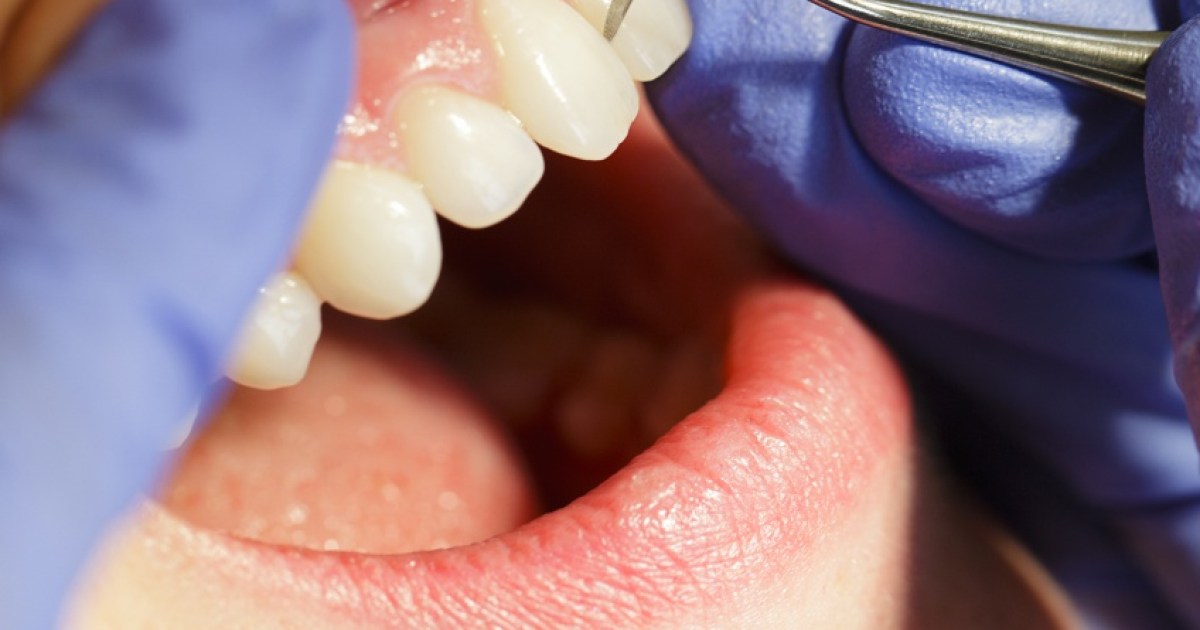Frightening consequences of not brushing teeth | The New Daily