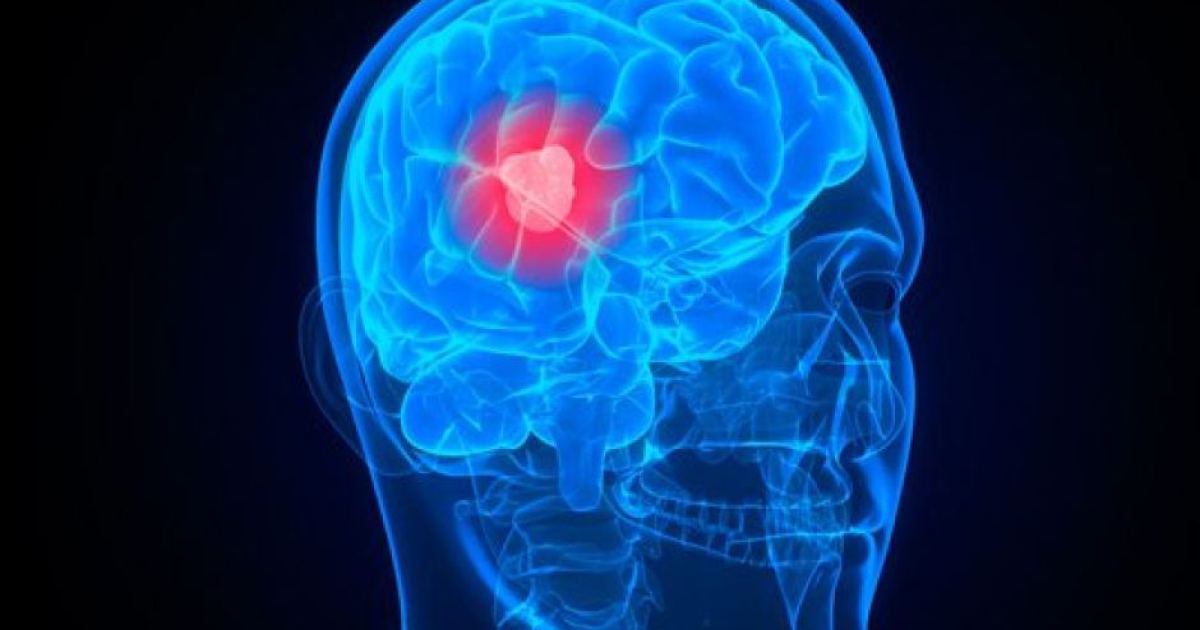 New $100m brain cancer fund aims to boost survival rates