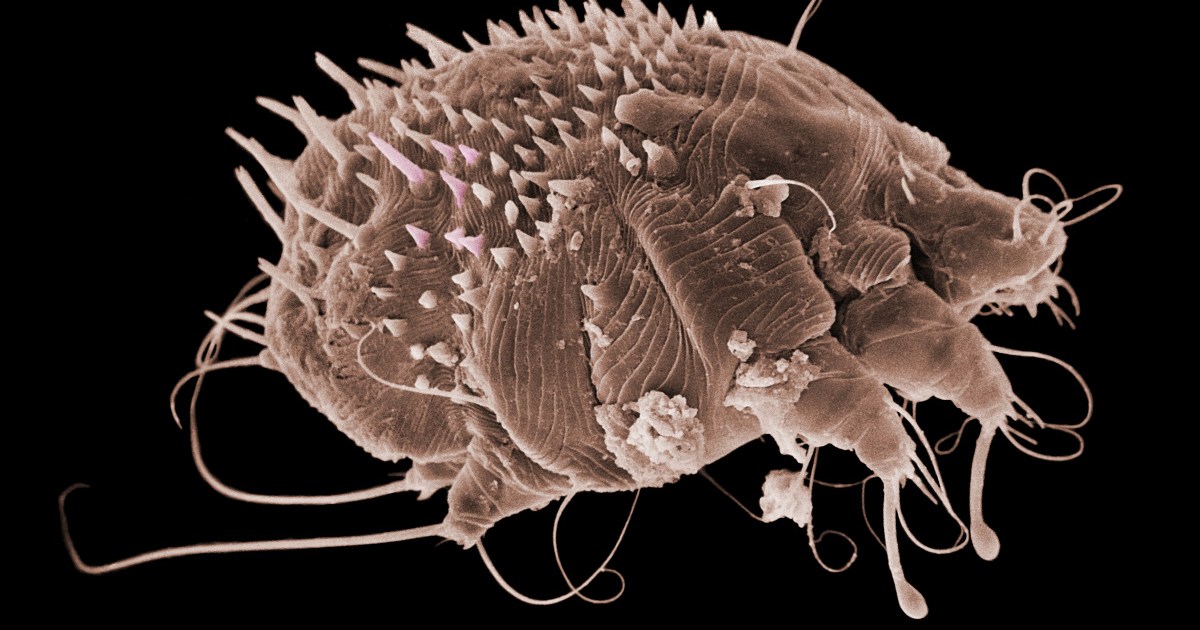 New hope for millions: Single-dose scabies treatment, new study