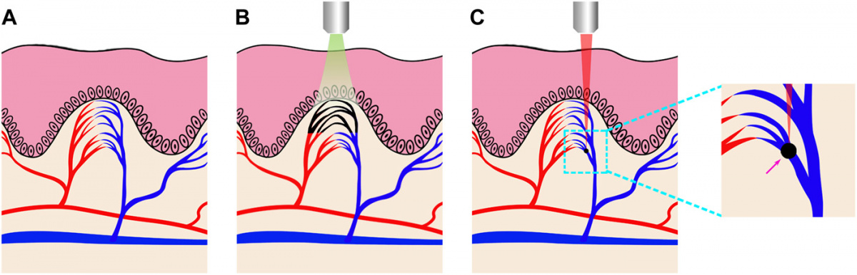 No cutting the skin, no bleeding, no scars: Surgery breakthrough