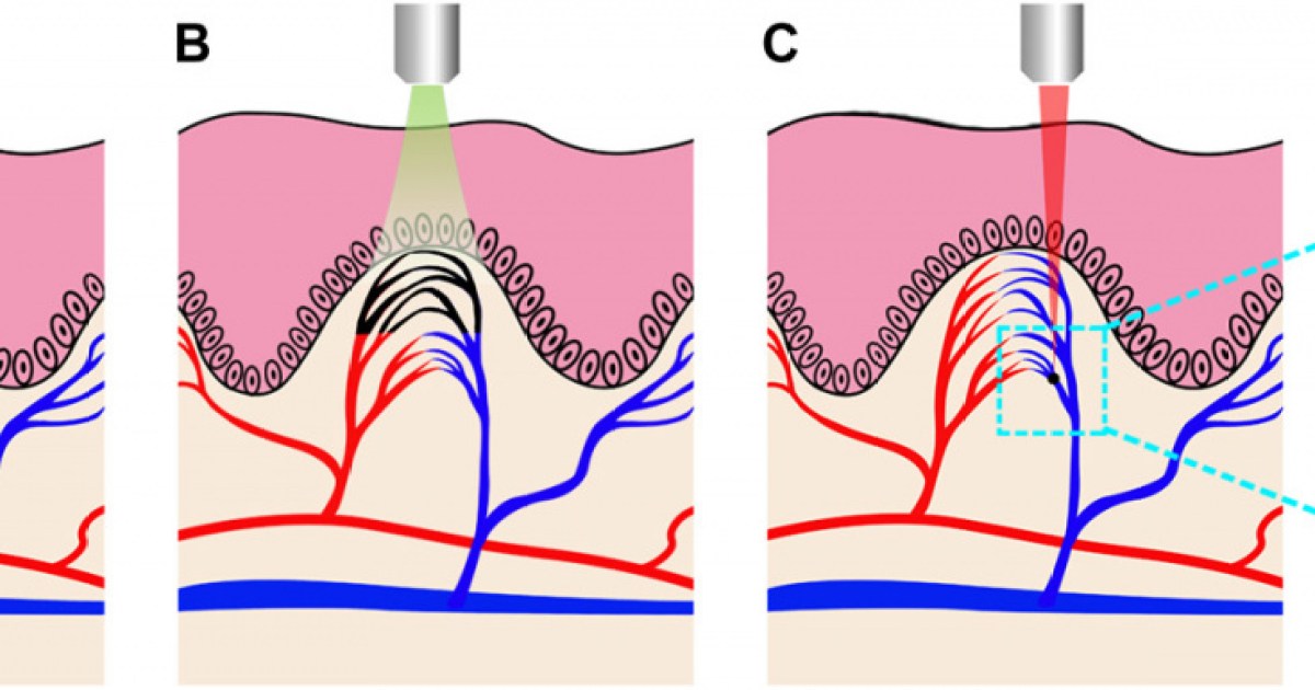 No cutting the skin, no bleeding, no scars: Surgery breakthrough
