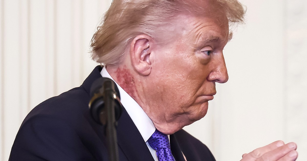 Rash on Donald Trump's neck reignites health speculation